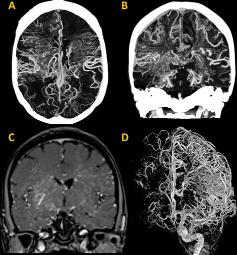 Diffuse Cerebral Proliferative Angiopathy Radiology