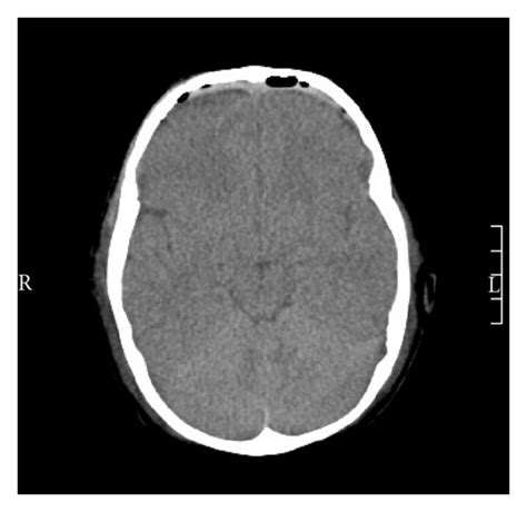 Postoperative Control Axial CT Scan Download Scientific Diagram