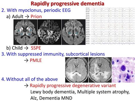 Algorithm For Dementia For Postgraduates Ppt