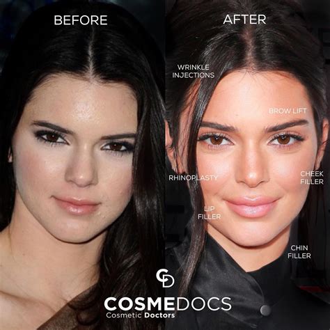 Face Fillers Celebrities At Manuel Hatchett Blog