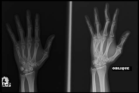Closed Fracture Of Left 4th Proximal Metacarpal Uni Clinic