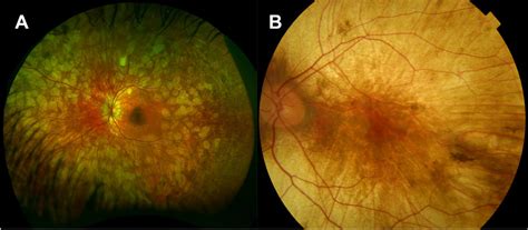 Choroideremia For Professionals Gene Vision