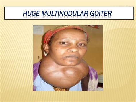 Ppt Diseases Of Thyroid Gland 1 Powerpoint Presentation Id 2141406