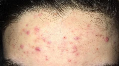 How To Get Rid Of Pimples In 1 Minute Youtube