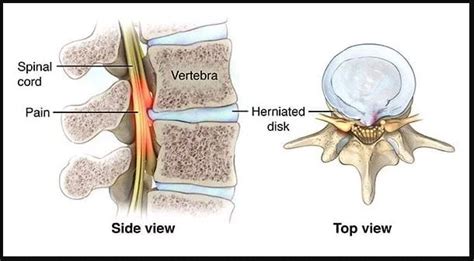 Posterior Cervical Compression Alleviated By Spinal Decompression Ep