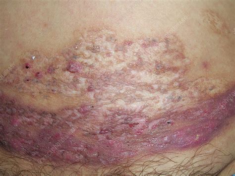 Pyoderma Gangrenosum Stock Image C056 5068 Science Photo Library