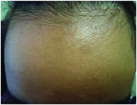 After Treatment With Ustekinumab Week 16 Download Scientific Diagram