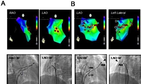 A Activation Map During Pvc1 Upper Panels And The Ablation Catheter