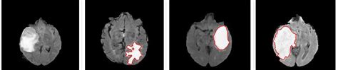 Towards Ai On Linkedin Python Tutorial Detecting A Brain Tumor With Ai