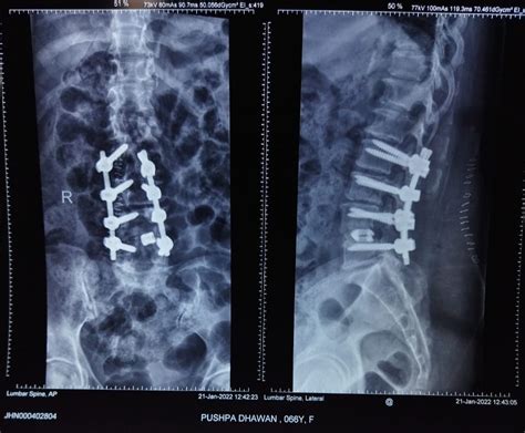 Degenerative Lumbar Scoliosis With Lateral Listhes Dr Pramod Saini