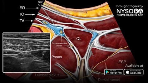 Quadratus Lumborum Ql3 Block Usg Guided Youtube The Efficacy Of