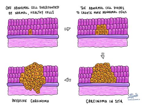 Carcinoma In Situ Cis Pathology Dictionary Mypathologyreportca