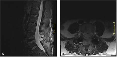 Dural Scarring And Repair Issues Clinical Tree