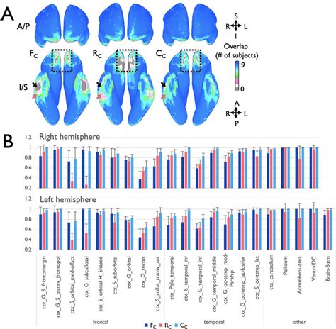 Comparison Of Cortical Coverage Ratio Between The Distortion Corrected