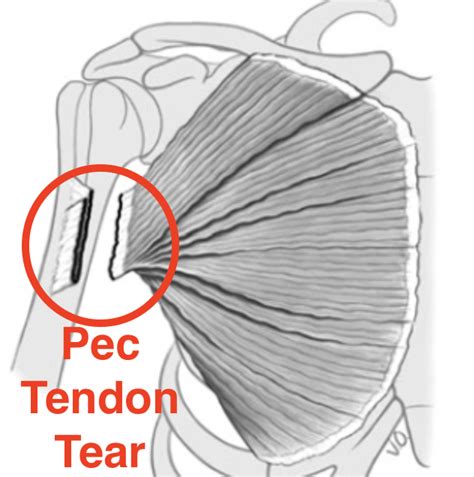 Pectoralis Tendon Tear Dr Edward Weldon