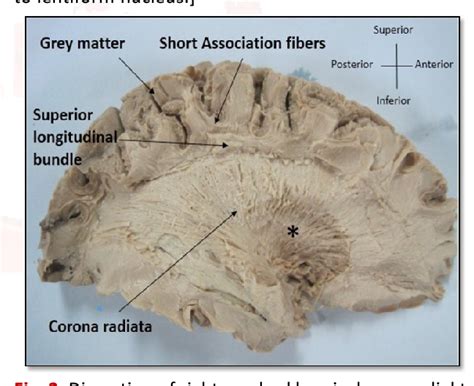 Figure 1 From Klinglers Fiber Dissection Method An Assisting Approach