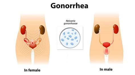 Common Symptoms Of Gonorrhea Entirely Health