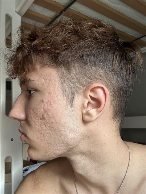 Did X2 Fractial Lasers R Acnescars