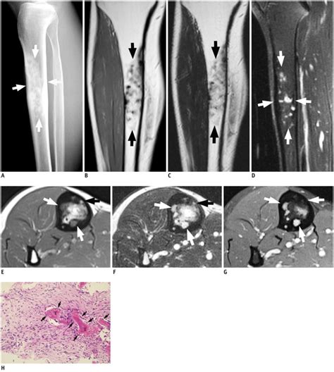 41 Year Old Woman Presented With Incidental Radiographic Abnormality In