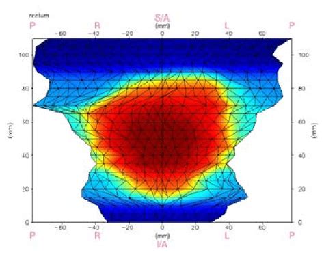 Example Of A Dose Surface Map Where The Dose To The Rectal Wall Has Download Scientific Diagram