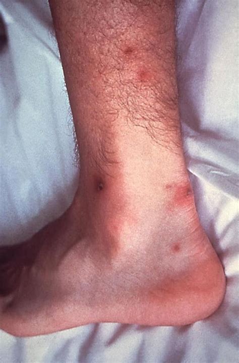 Gonorrhea Gonorrhea Msd Manual Consumer Version