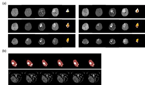 Clinical Dataset For Training Segmentation Model A Brats Is A