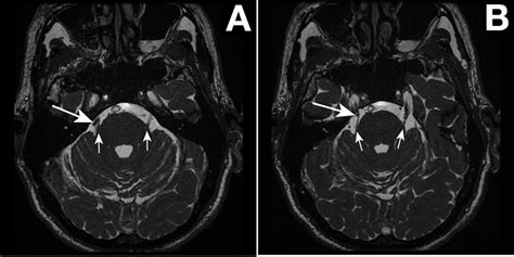 Trigeminal Nerve Mri Sagittal