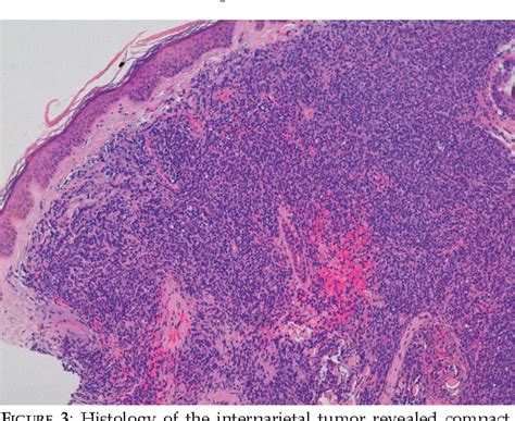 Figure 4 From Blastic Plasmacytoid Dendritic Cell Neoplasm Semantic Scholar
