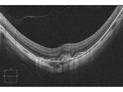 High Myopia With Choroidal Neovascularization Cnv Eyecarepd
