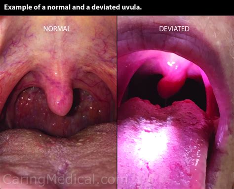Uvula Deviation