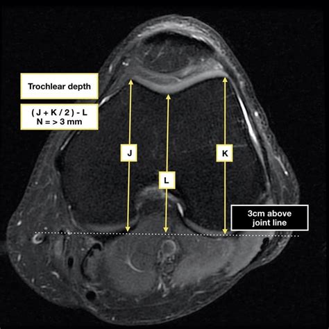 A Trochlear Depth Of