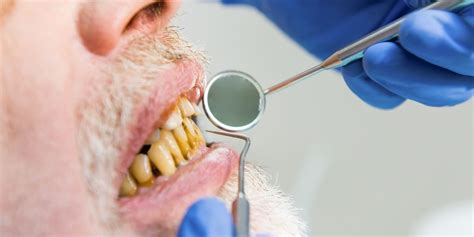 Stages Of Tooth Decay Signs And Dental Treatment Options