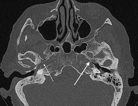 Carotid Canal Temporal Bone Inferior View Of The Carotid Canal And