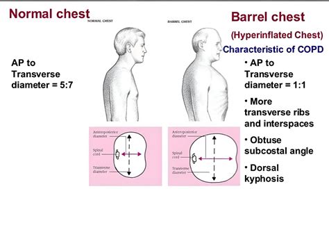 What Disease Causes Barrel Chest