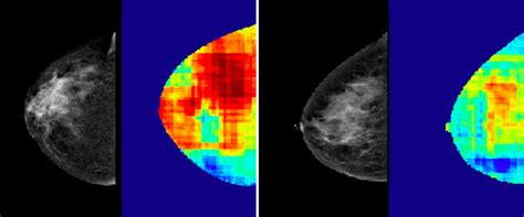 Can Artificial Intelligence Predict Breast Cancer