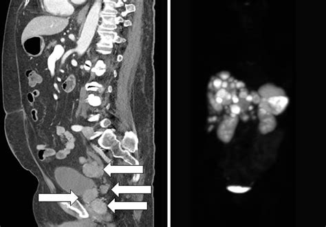 Importance Of Prompt Treatment For Severe Hypercortisolism Secondary To