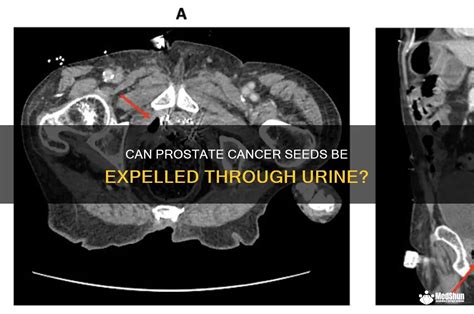 Can Prostate Cancer Seeds Be Expelled Through Urine Medshun