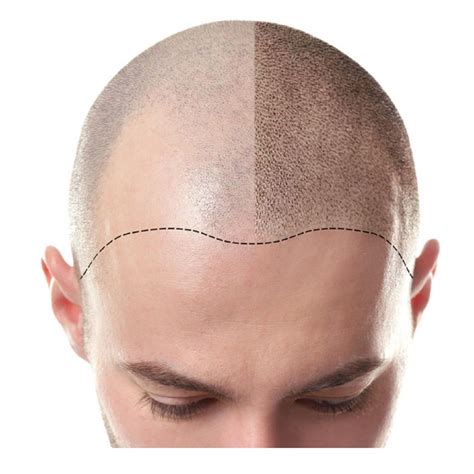 Scalp Micropigmentation Light Touch Permanent Makeup Scalp Micropigmentation Light Touch Permanent Makeup