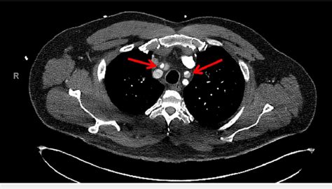 Axial Section Dissection Extending Into The Right And Left Common