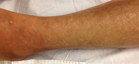 EOSINOPHILIC FASCIITIS AND EFFECT OF HOMOEOPATHY ON IT