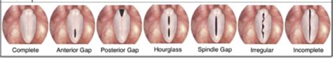 voice exam 2 pathologies images flashcards quizlet