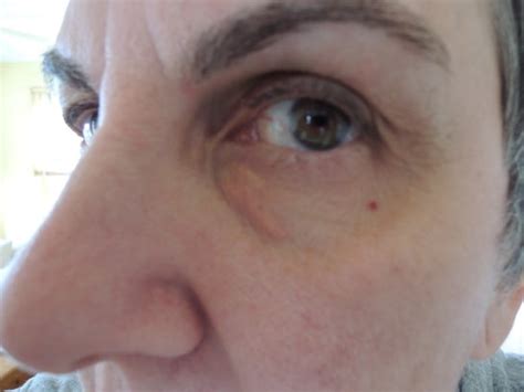 Sudden Red Spot On Eye