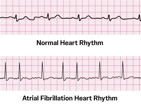 What Is Afib Of The Heart Signs And Symptoms