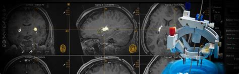 Smartframe Array Neuro Navigation System Clearpoint Neuro