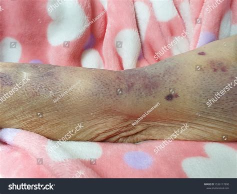 Skin Disease Lesion Ecchymosis Vasculitis ภาพสต็อก แก้ไขตอนนี้