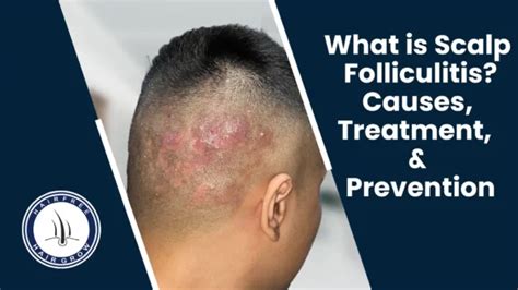 Scalp Folliculitis Causes Symptoms And Treatment 2026