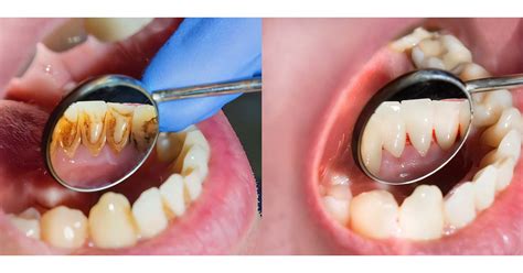 Tooth Scaling Truths Every Dentist Should Share With Patients Dentalkart Tooth Scaling Truths Every Dentist Should Share With Patients Dentalkart