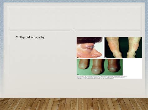 Hyperthyroidism Mainly From Harrisonpptx