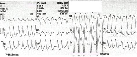Supraventricular Atrial Fibrillation Accessory Excited Pre Patient