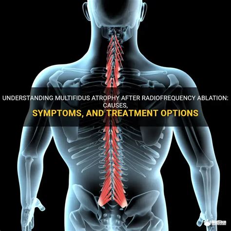 Understanding Multifidus Atrophy After Radiofrequency Ablation Causes